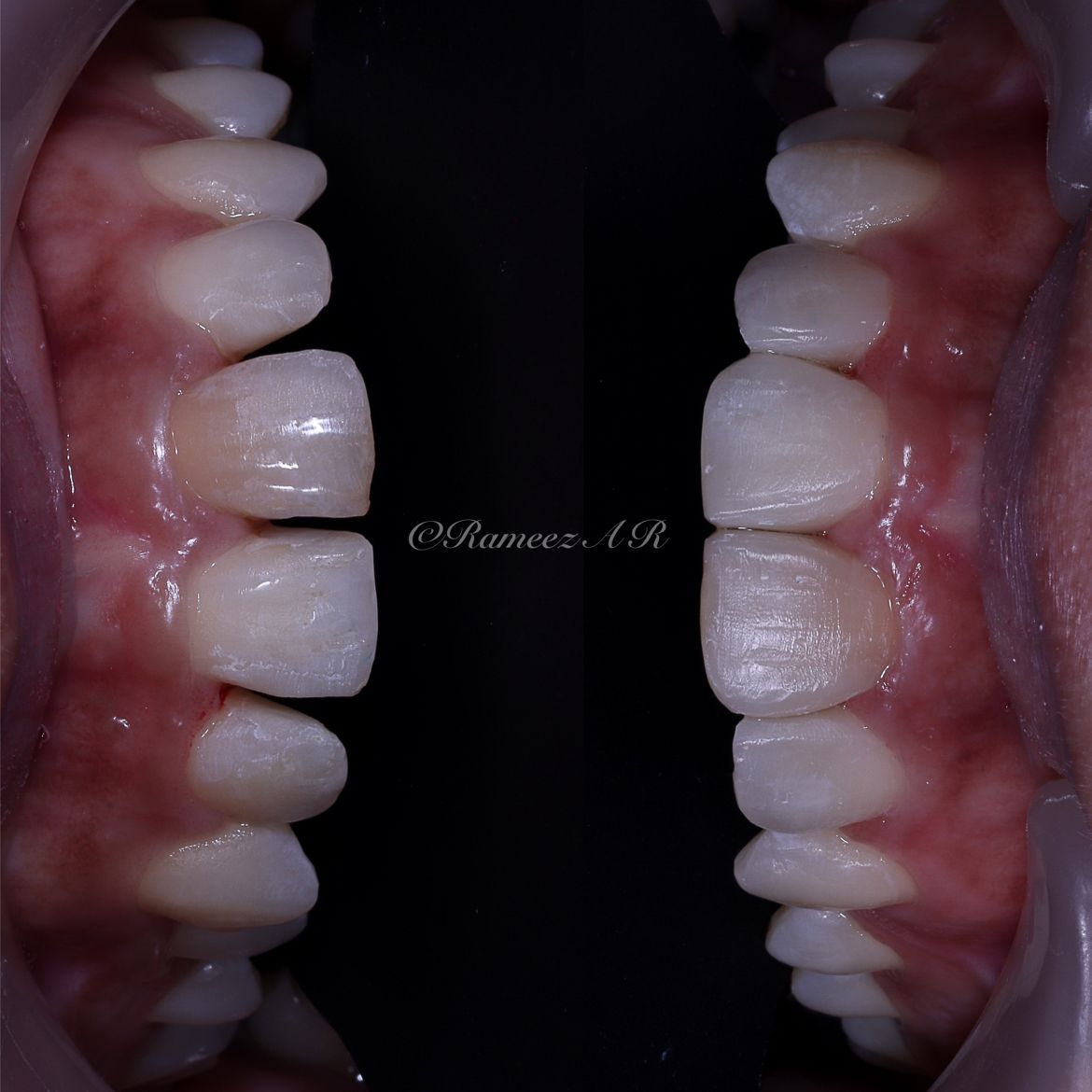 Abdul Rahiman Rameez on LinkedIn: #caries #anterior #incisor # ... Abdul Rahiman Rameez on LinkedIn: #caries #anterior #incisor # ...