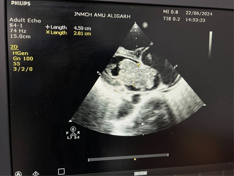 Mohammad Saquib Alam on LinkedIn: #cardiology #echo #casereport # ... Mohammad Saquib Alam on LinkedIn: #cardiology #echo #casereport # ...