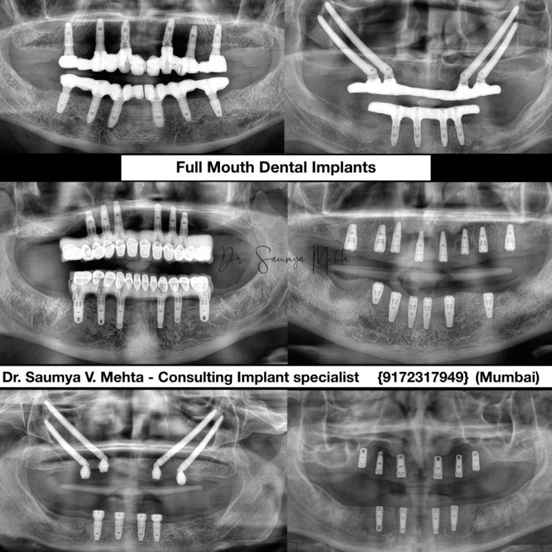 Dr Saumya Mehta on LinkedIn: Full mouth implant specialist Dr Saumya Mehta on LinkedIn: Full mouth implant specialist