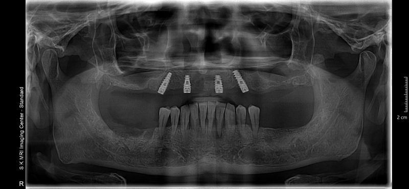 Dr.Harsh Shah on LinkedIn: #implantology #dentistry Dr.Harsh Shah on LinkedIn: #implantology #dentistry