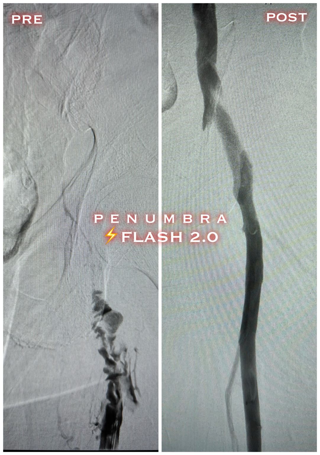 James Reyes, RN on LinkedIn: L👀k at those beautifully preserved venous ... James Reyes, RN on LinkedIn: L👀k at those beautifully preserved venous ...