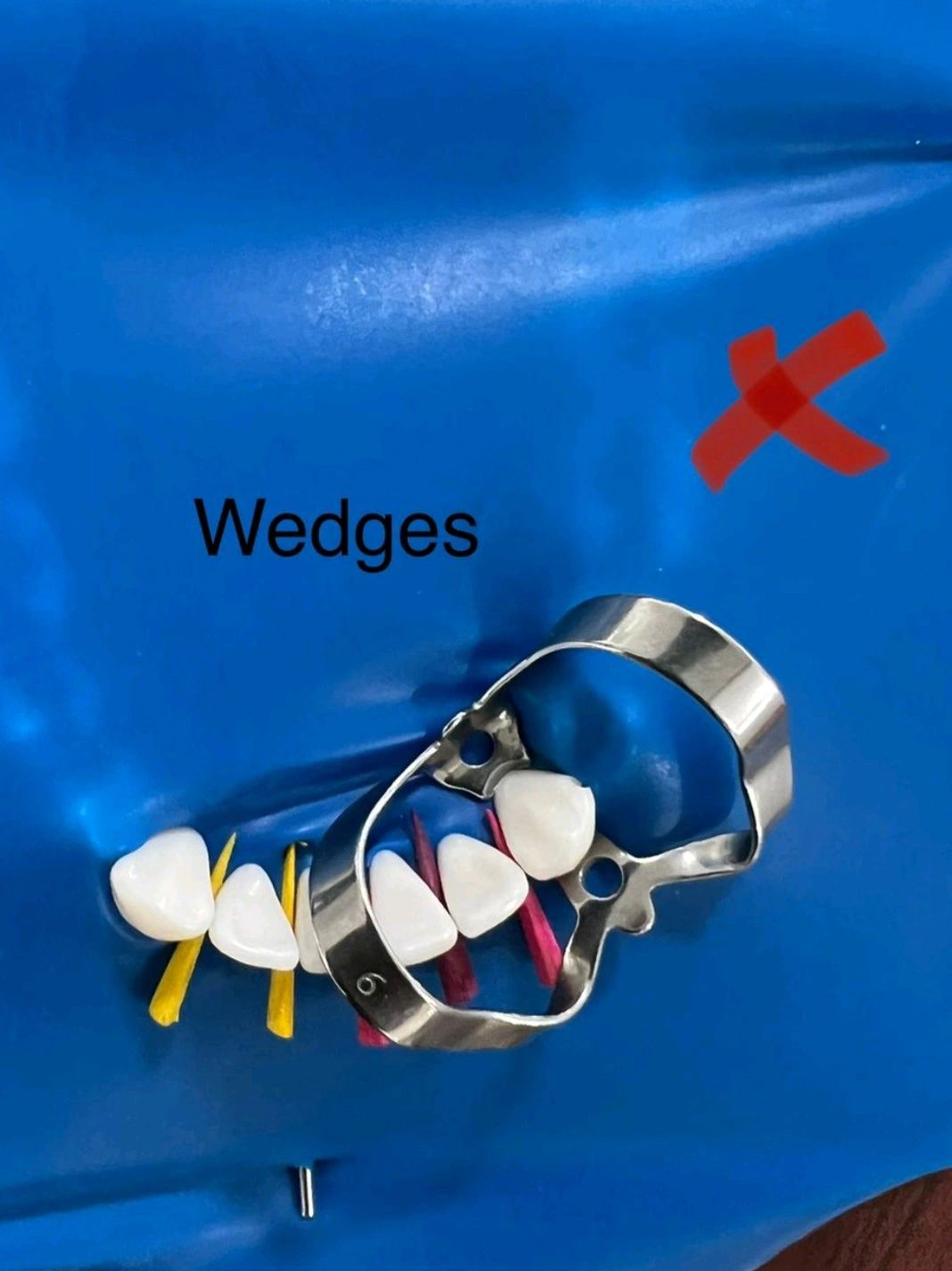 Dr.Akshita Bansal on LinkedIn: #conservativedentistry #dental # ... Dr.Akshita Bansal on LinkedIn: #conservativedentistry #dental # ...