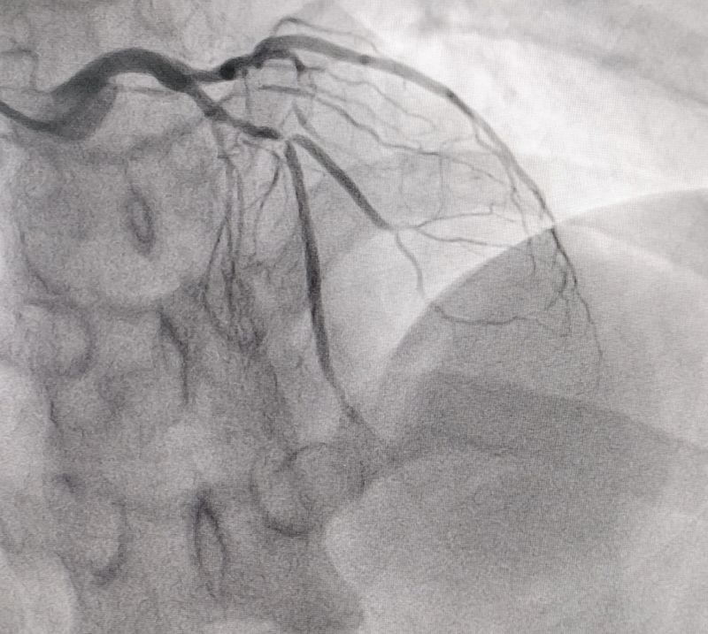 MOHAMMED RINSHAD PT on LinkedIn: 49/M Patient DIAGNOSIS: EVOLVED AWMI ... MOHAMMED RINSHAD PT on LinkedIn: 49/M Patient DIAGNOSIS: EVOLVED AWMI ...