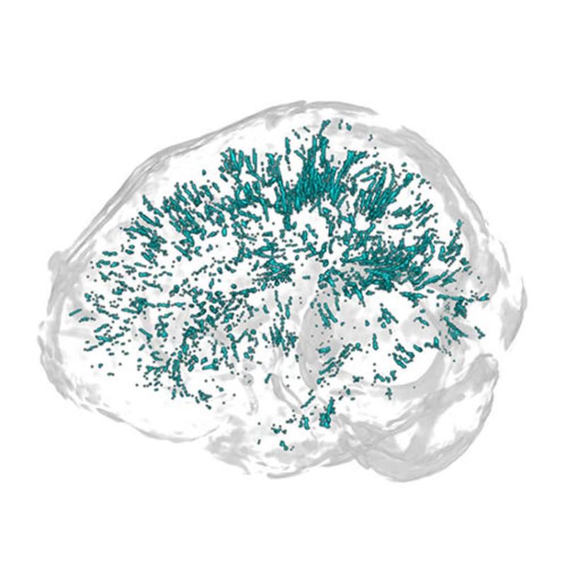 Dewmi L. on LinkedIn: Ultra-high-res MRI Reveals Migraine Brain Changes Dewmi L. on LinkedIn: Ultra-high-res MRI Reveals Migraine Brain Changes