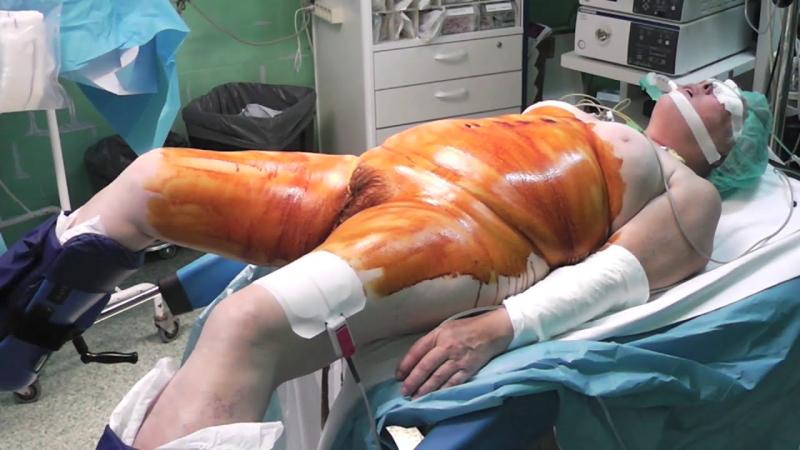 Gonzalo P. Martin-Martin, PhD, FEBColoproctology, FRoboticsCS on ... Gonzalo P. Martin-Martin, PhD, FEBColoproctology, FRoboticsCS on ...