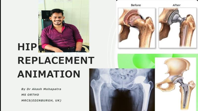 Dr. Akash Mohapatra on LinkedIn: š§āāļøHIP REPLACEMENT ANIMATION šÆ By Dr ... Dr. Akash Mohapatra on LinkedIn: š§āāļøHIP REPLACEMENT ANIMATION šÆ By Dr ...