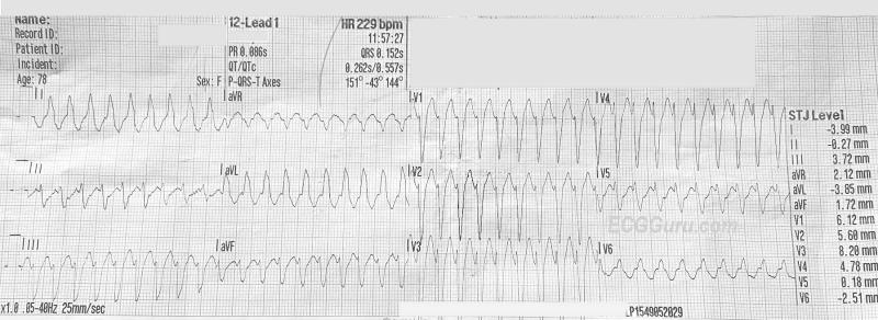 ECG Guru on LinkedIn: Instructors' Collection ECG: Wide Complex Tachycardia ECG Guru on LinkedIn: Instructors' Collection ECG: Wide Complex Tachycardia