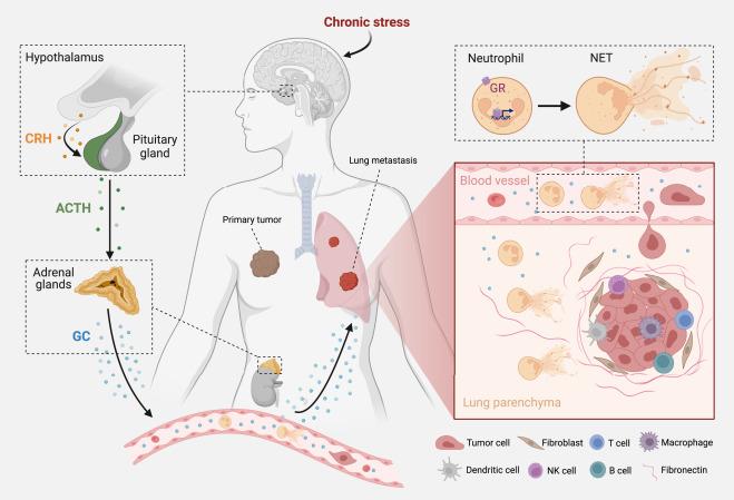 Mohammad Vaziri on LinkedIn: Stress-induced metastasis: The NET effect Mohammad Vaziri on LinkedIn: Stress-induced metastasis: The NET effect