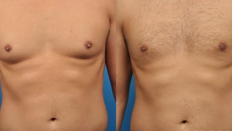 Tamira Plastic Surgery on LinkedIn: Understanding Gynecomastia: Causes ... Tamira Plastic Surgery on LinkedIn: Understanding Gynecomastia: Causes ...