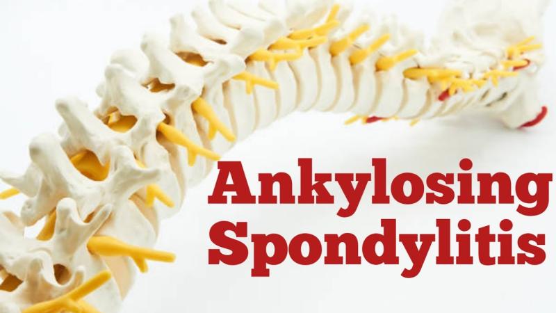 Dr. Khalil Ur Rehman PT on LinkedIn: Ankylosing Spondylitis- Symptoms ... Dr. Khalil Ur Rehman PT on LinkedIn: Ankylosing Spondylitis- Symptoms ...