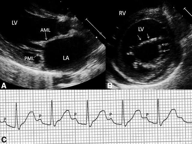Dr.Gourav S. on LinkedIn: Acute Rheumatic Fever - by Dr Gourav Sharma ... Dr.Gourav S. on LinkedIn: Acute Rheumatic Fever - by Dr Gourav Sharma ...