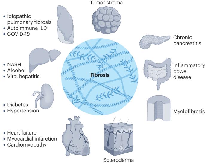 Sumeet Pandey, PhD on LinkedIn: Immunology of human fibrosis - Nature ... Sumeet Pandey, PhD on LinkedIn: Immunology of human fibrosis - Nature ...