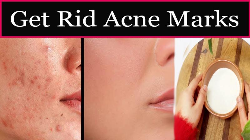 Qudrat Beauty Secrets on LinkedIn: How To Get Rid Acne Marks | How To ... Qudrat Beauty Secrets on LinkedIn: How To Get Rid Acne Marks | How To ...