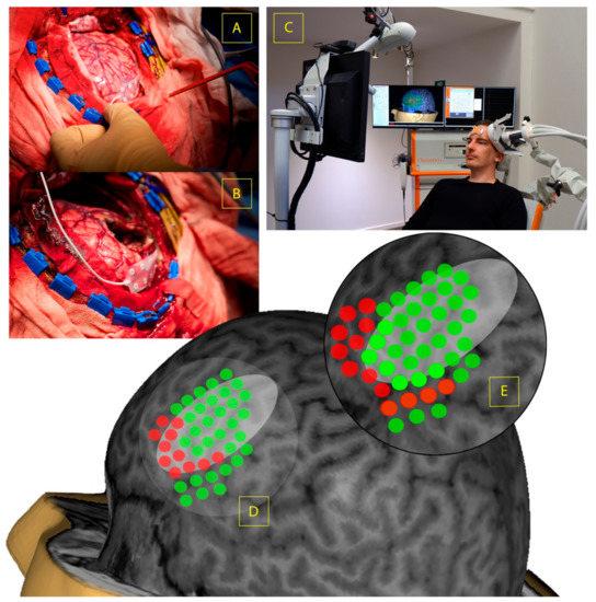 Life MDPI on LinkedIn: Current Status of Neuromodulation-Induced ... Life MDPI on LinkedIn: Current Status of Neuromodulation-Induced ...