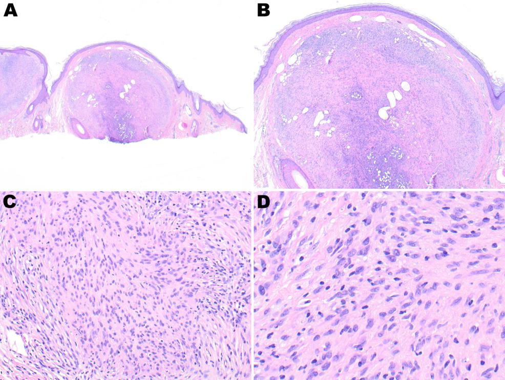 Muhammad Tahir, MD, MS on LinkedIn: Malignant Cutaneous Neurocristic ... Muhammad Tahir, MD, MS on LinkedIn: Malignant Cutaneous Neurocristic ...