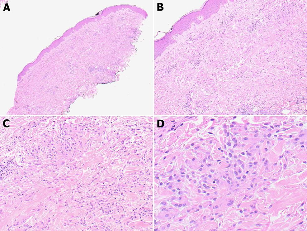 Muhammad Tahir, MD, MS on LinkedIn: Dermal Granuloma Annulare After ... Muhammad Tahir, MD, MS on LinkedIn: Dermal Granuloma Annulare After ...