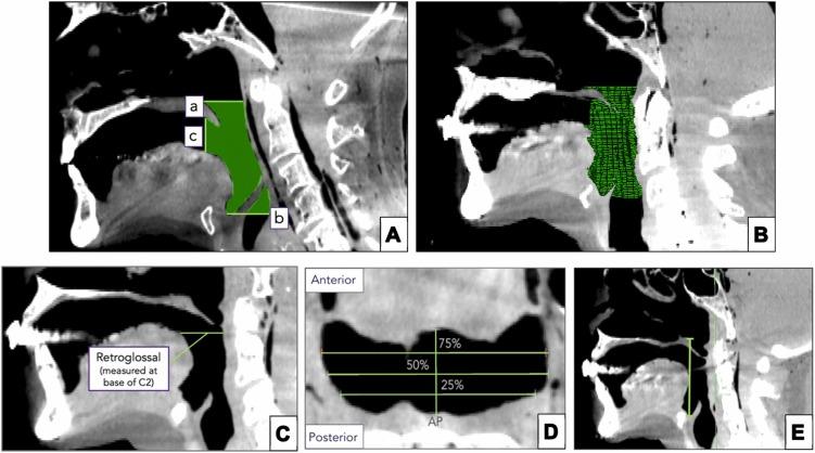 Moulik Patel on LinkedIn: The effects of incremental maxillomandibular ... Moulik Patel on LinkedIn: The effects of incremental maxillomandibular ...