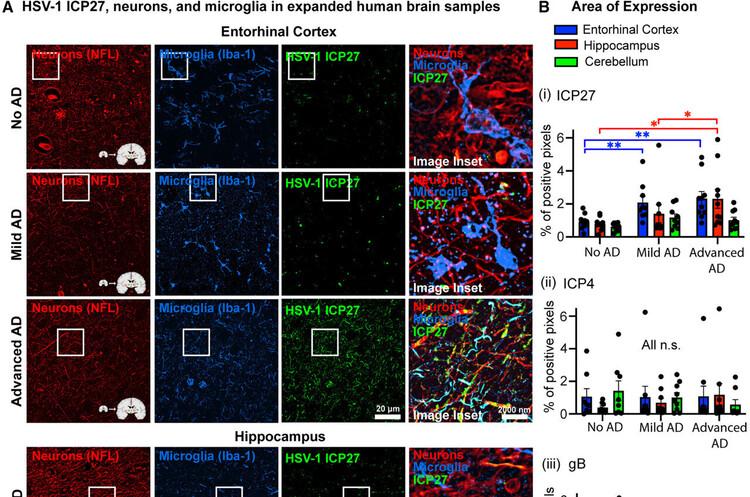 John Guanjing Zhang on LinkedIn: Herpes virus might drive Alzheimer's ... John Guanjing Zhang on LinkedIn: Herpes virus might drive Alzheimer's ...