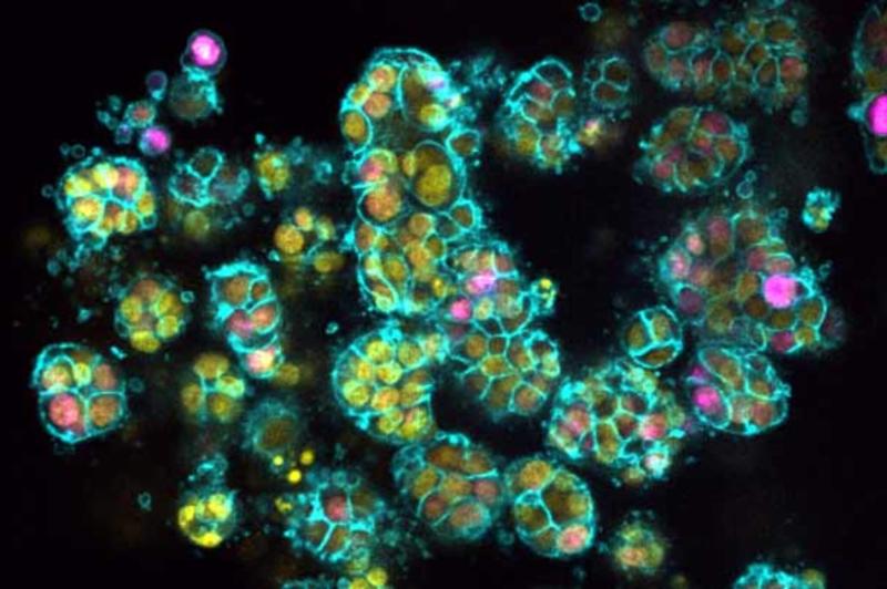 William(Pat) Riggs on LinkedIn: First-of-its-kind pancreatic cancer ... William(Pat) Riggs on LinkedIn: First-of-its-kind pancreatic cancer ...