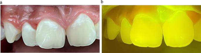Evaluation of a novel caries detecting oral rinse - BDJ Open | Nathan Jones Evaluation of a novel caries detecting oral rinse - BDJ Open | Nathan Jones