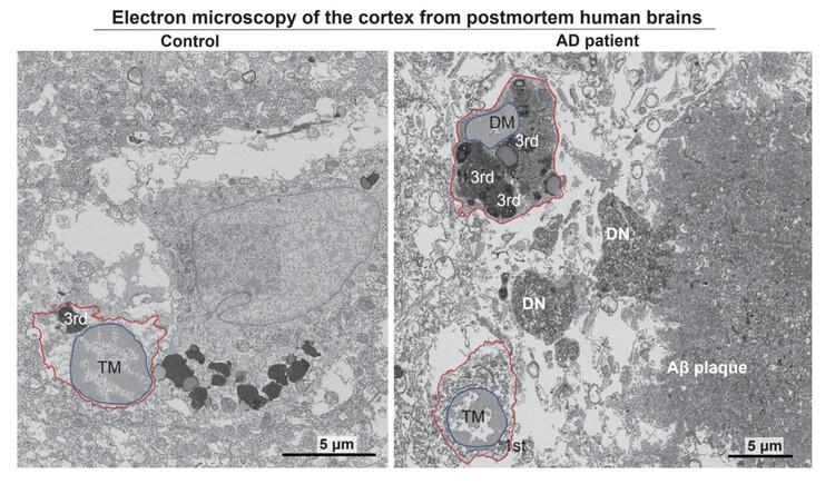 John Guanjing Zhang on LinkedIn: Alzheimer's progression tied to stress ... John Guanjing Zhang on LinkedIn: Alzheimer's progression tied to stress ...