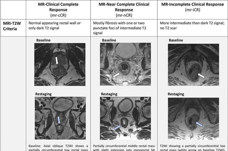 John Guanjing Zhang on LinkedIn: MRI can save rectal cancer patients ... John Guanjing Zhang on LinkedIn: MRI can save rectal cancer patients ...
