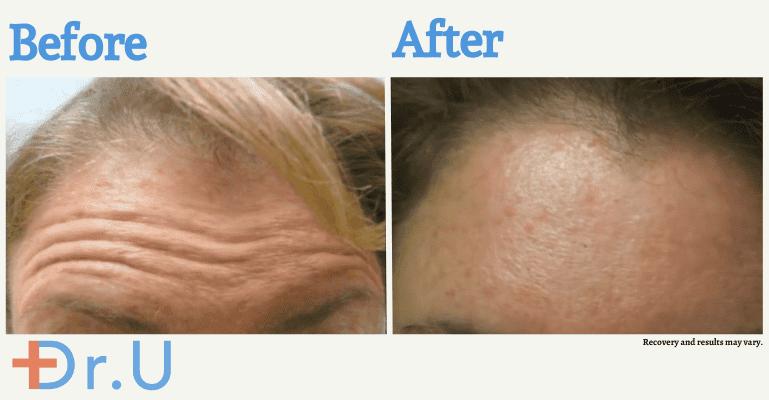 Sanusi Umar, MD on LinkedIn: Is Daxxify Better Than Botox? Sanusi Umar, MD on LinkedIn: Is Daxxify Better Than Botox?