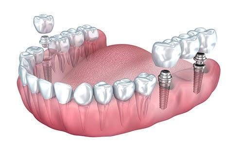 Dental Implants in India: Indications, Contraindications, and Cost | Dr ... Dental Implants in India: Indications, Contraindications, and Cost | Dr ...
