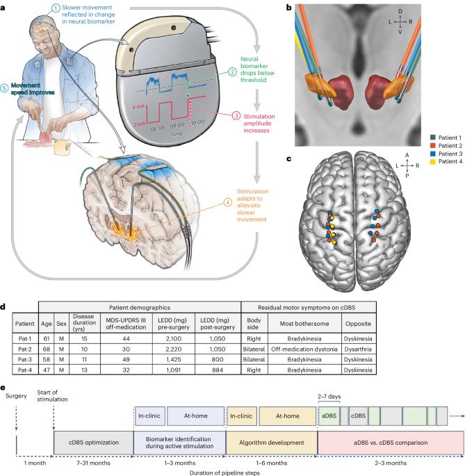 Adam Hammer on LinkedIn: Chronic adaptive deep brain stimulation versus ... Adam Hammer on LinkedIn: Chronic adaptive deep brain stimulation versus ...