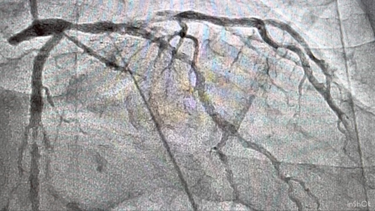Dr Ankit Gupta LinkedIn‘de: #aiims #cardiology Dr Ankit Gupta LinkedIn‘de: #aiims #cardiology