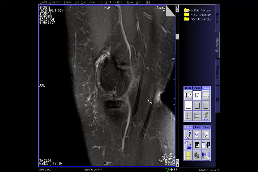 #3dknee #kneemri #mri #knee #3d | Iman Azinkhah #3dknee #kneemri #mri #knee #3d | Iman Azinkhah