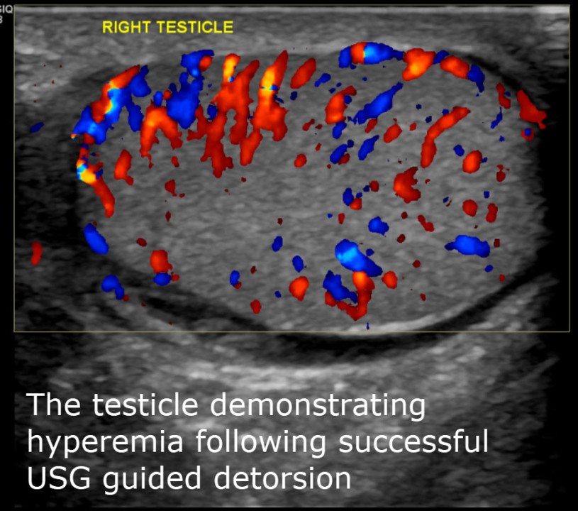 Doppler ultrasound guided de-torsion of testicular torsion Doppler ultrasound guided de-torsion of testicular torsion