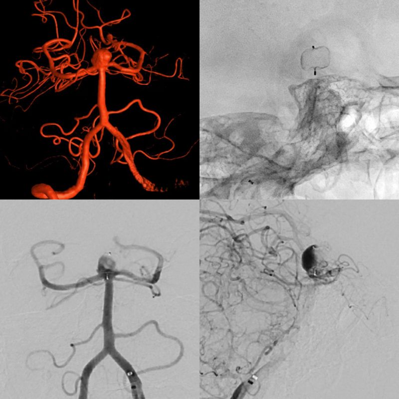 Sabareesh Natarajan on LinkedIn: #brainaneurysmsurvivor #neurosurgery # ... Sabareesh Natarajan on LinkedIn: #brainaneurysmsurvivor #neurosurgery # ...