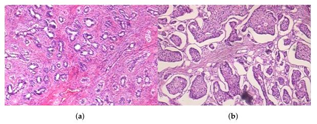 #computationmdpi #idc #breastcancer #histopathology #computation ... #computationmdpi #idc #breastcancer #histopathology #computation ...