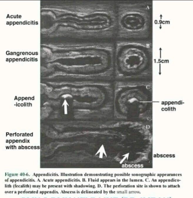 Shivam Jha on LinkedIn: #ultrasound #appendix #ultrasoundtechnician # ... Shivam Jha on LinkedIn: #ultrasound #appendix #ultrasoundtechnician # ...