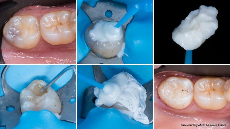 GC America on LinkedIn: Next to the injection moulding technique G ... GC America on LinkedIn: Next to the injection moulding technique G ...