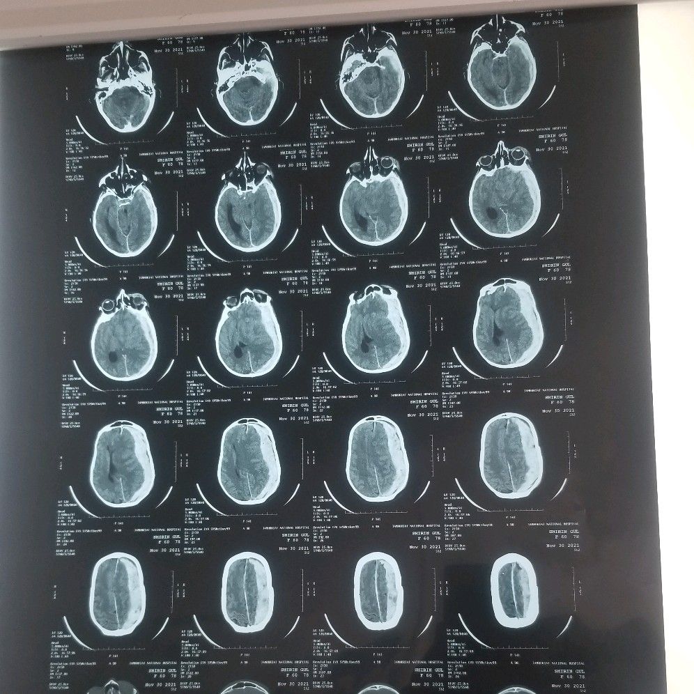 Shafi ullah Zahid on LinkedIn: massive acute subdural hematoma Shafi ullah Zahid on LinkedIn: massive acute subdural hematoma
