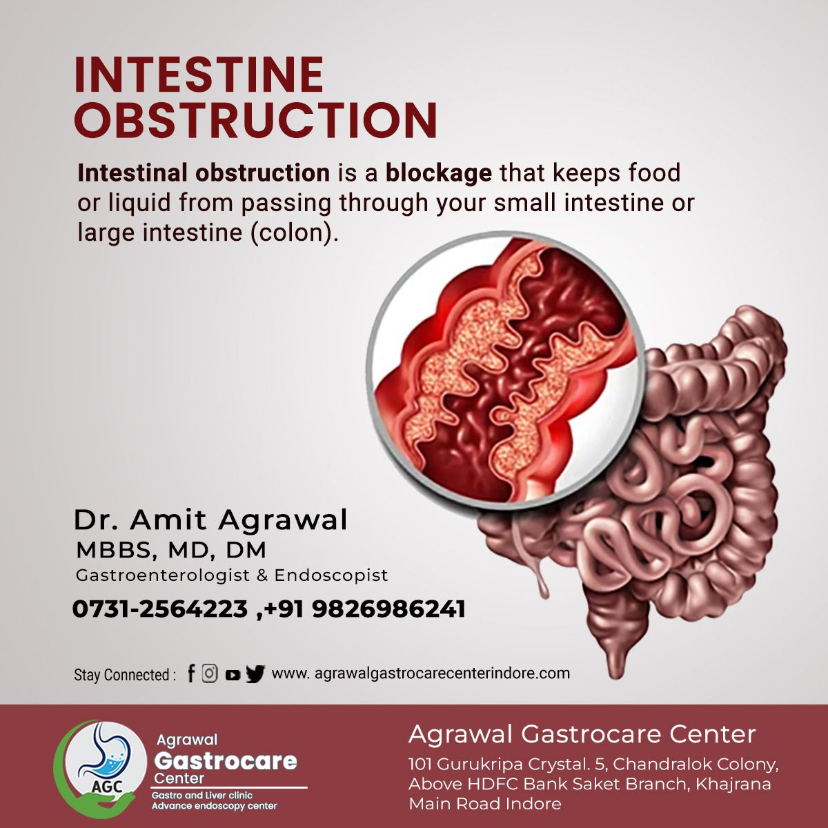 Dr. Amit Agrawal Agrawal Gastrocare Center Indore on LinkedIn: # ... Dr. Amit Agrawal Agrawal Gastrocare Center Indore on LinkedIn: # ...