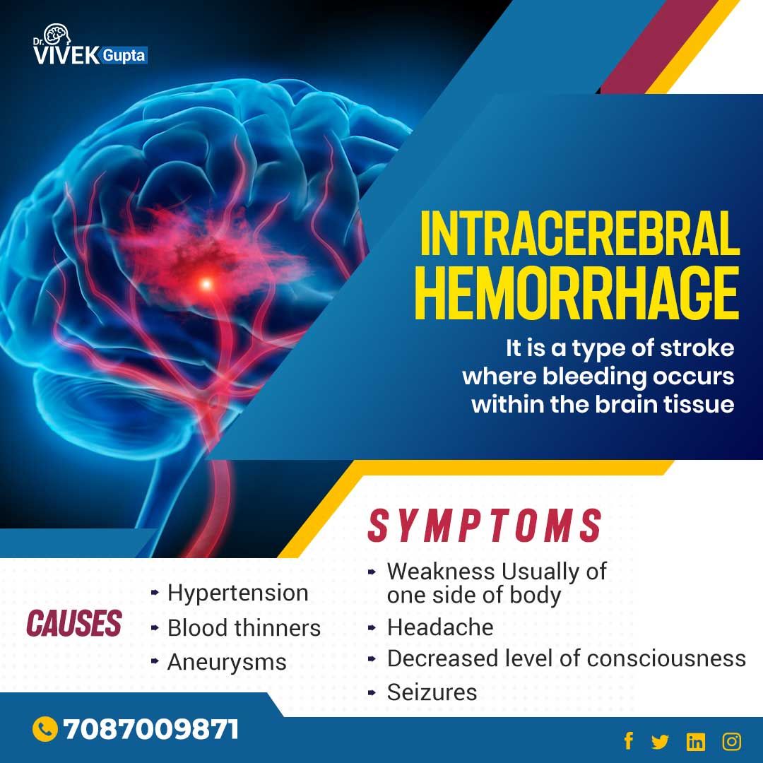 Dr. Vivek Gupta LinkedIn‘de: #hemorrhage #intracerebralhemorrhage # ... Dr. Vivek Gupta LinkedIn‘de: #hemorrhage #intracerebralhemorrhage # ...