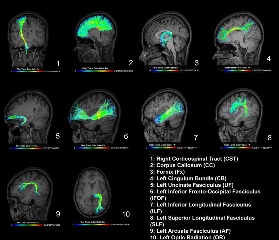 Predominant polarity as a neurobiological specifier in bipolar disorder ... Predominant polarity as a neurobiological specifier in bipolar disorder ...