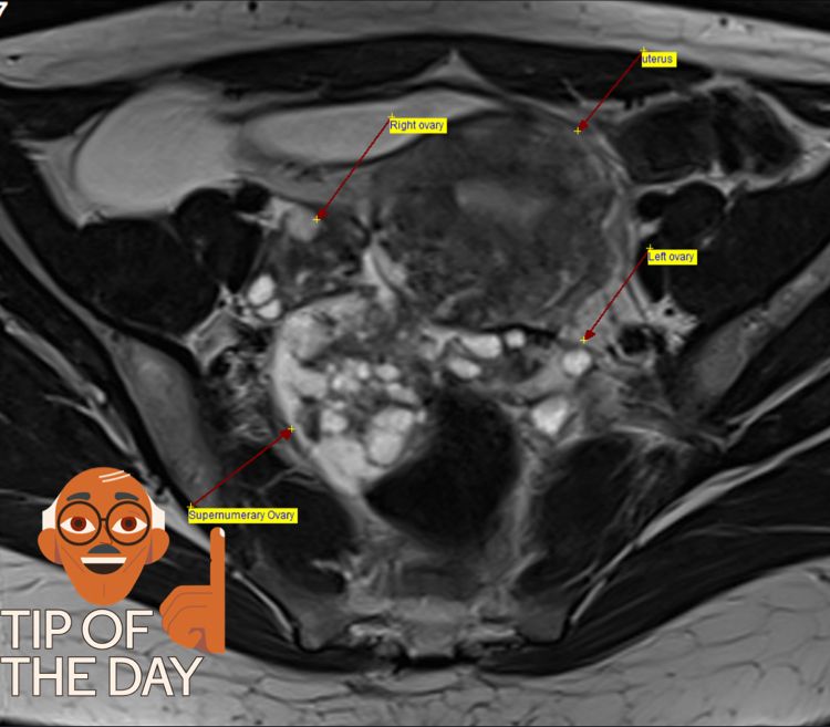 Mohamed Shemais on LinkedIn: #female_imaging #accessoryovary # ... Mohamed Shemais on LinkedIn: #female_imaging #accessoryovary # ...