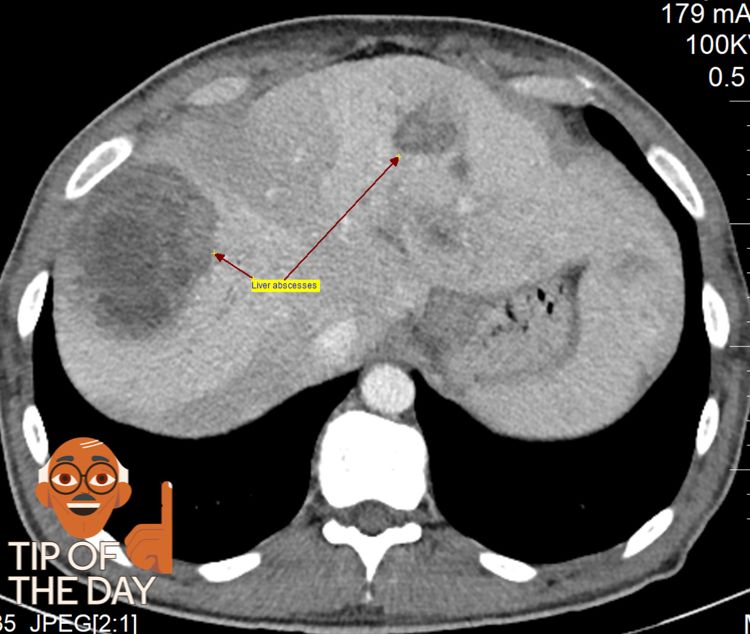 Mohamed Shemais on LinkedIn: #git_imaging #crohn #radiology #ct # ... Mohamed Shemais on LinkedIn: #git_imaging #crohn #radiology #ct # ...