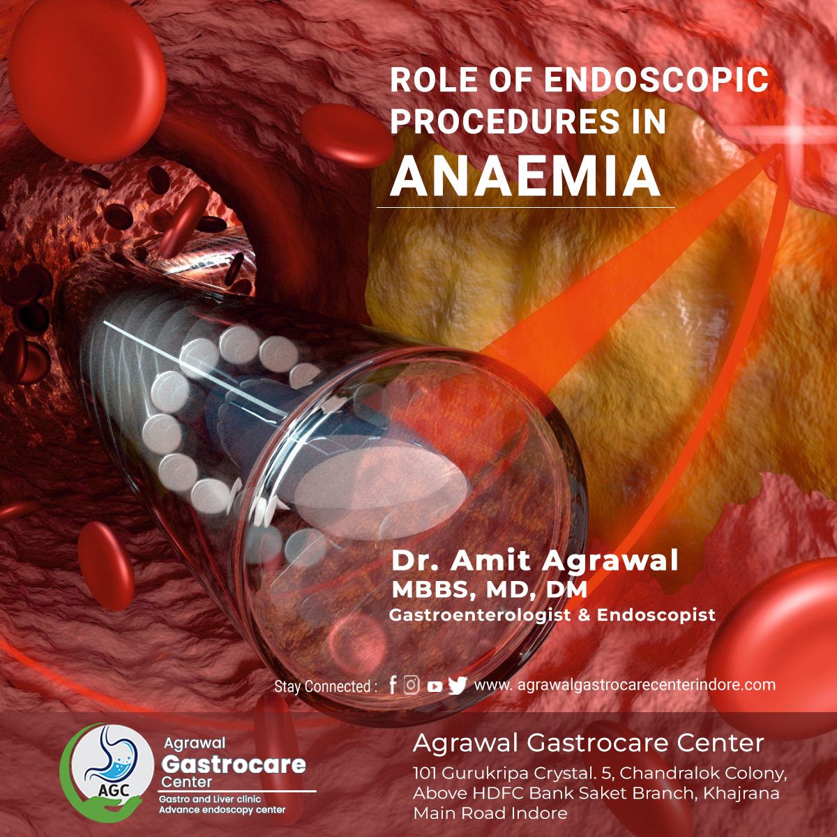 Dr. Amit Agrawal Agrawal Gastrocare Center Indore on LinkedIn: #anaemia ... Dr. Amit Agrawal Agrawal Gastrocare Center Indore on LinkedIn: #anaemia ...
