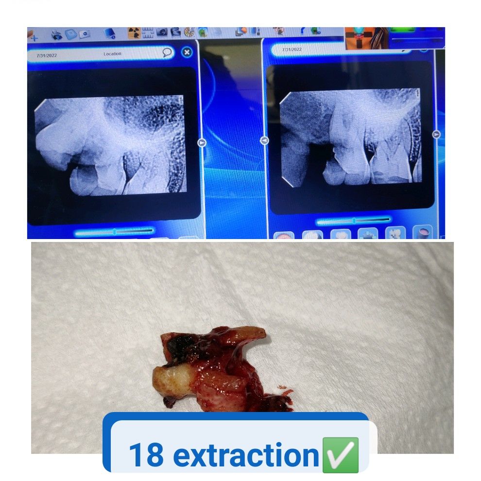 Dr.Harsh Verma on LinkedIn: 18 extraction Dr.Harsh Verma on LinkedIn: 18 extraction