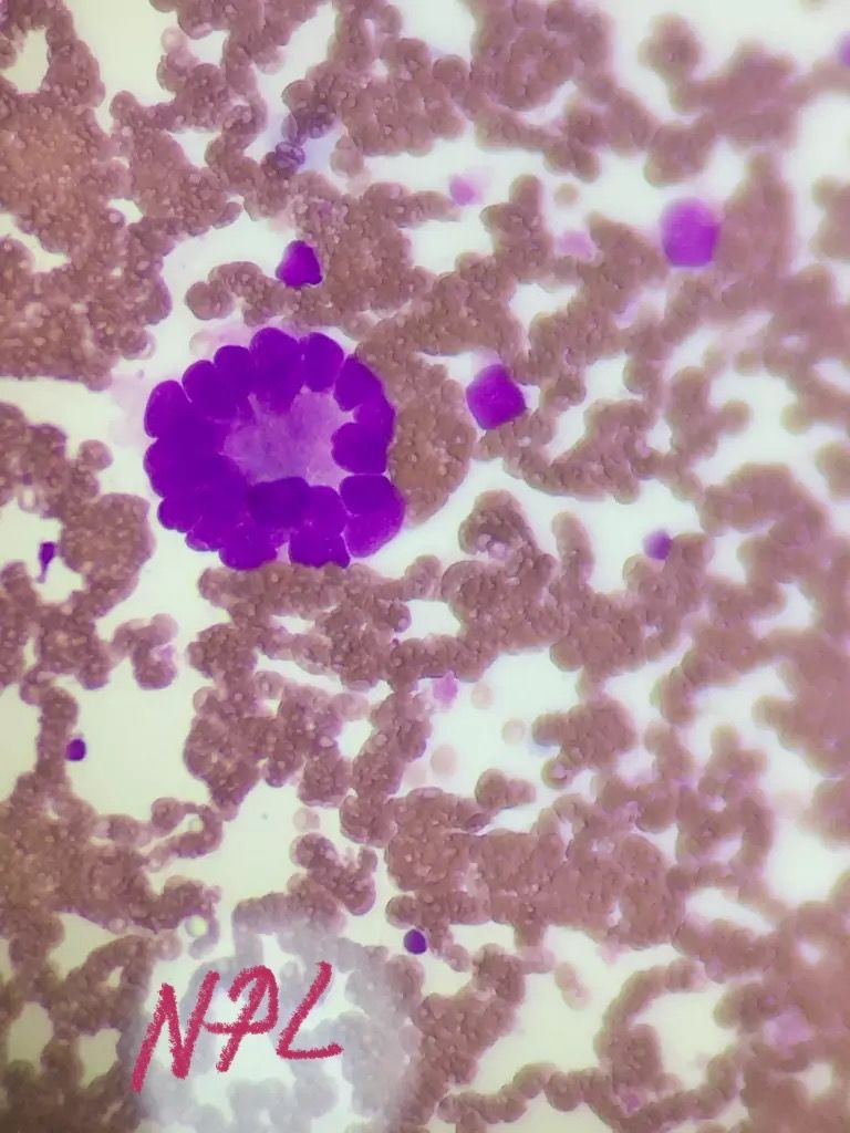 LinkedIn Nasir Ahmad Nasir 페이지: Wreath-like multinucleated giant cells ... LinkedIn Nasir Ahmad Nasir 페이지: Wreath-like multinucleated giant cells ...
