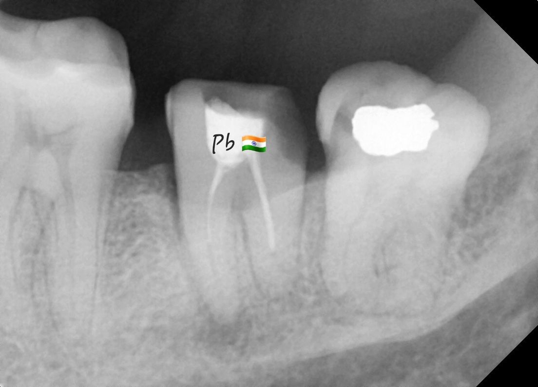Dr. Prashant Bhasin on LinkedIn: #endodonticretreament #guttaclear Dr. Prashant Bhasin on LinkedIn: #endodonticretreament #guttaclear