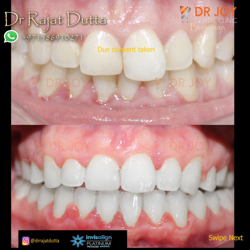 #orthodontist #braces #invisalign #invisalignbeforeandafter # ... #orthodontist #braces #invisalign #invisalignbeforeandafter # ...