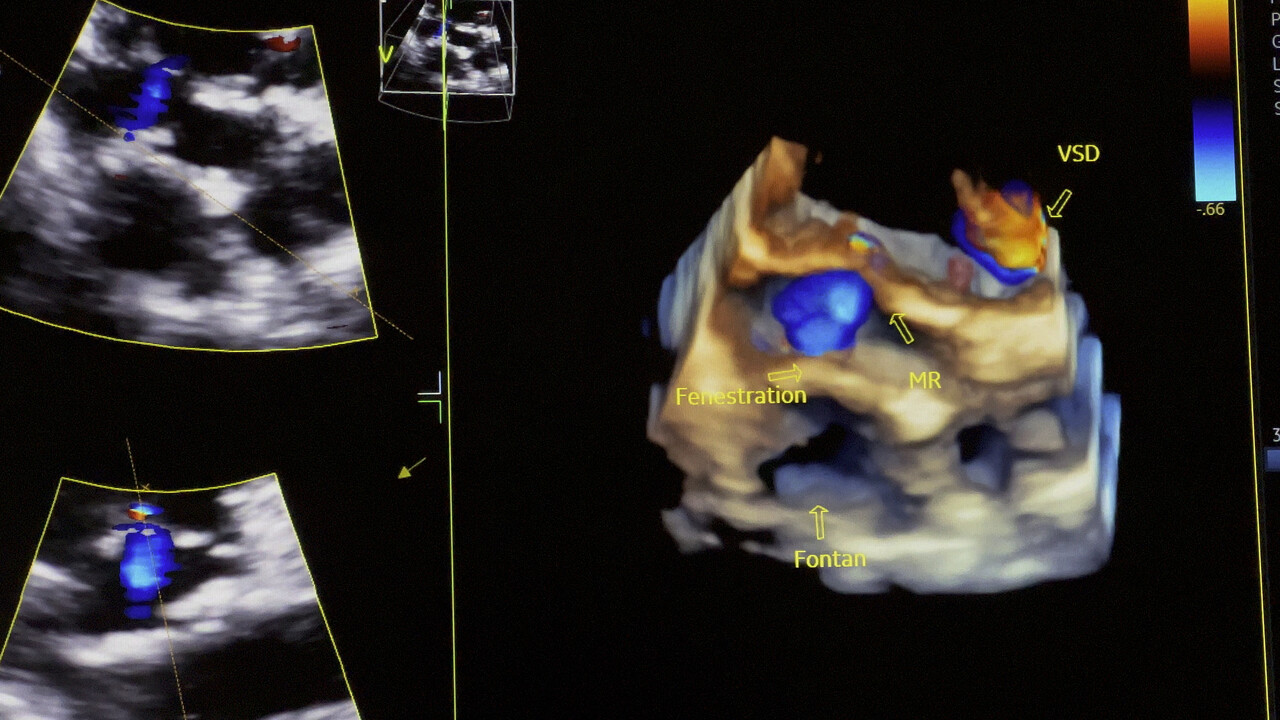 3D zoom image of the mitral valve, Fontan and VSD. This is from a ... 3D zoom image of the mitral valve, Fontan and VSD. This is from a ...