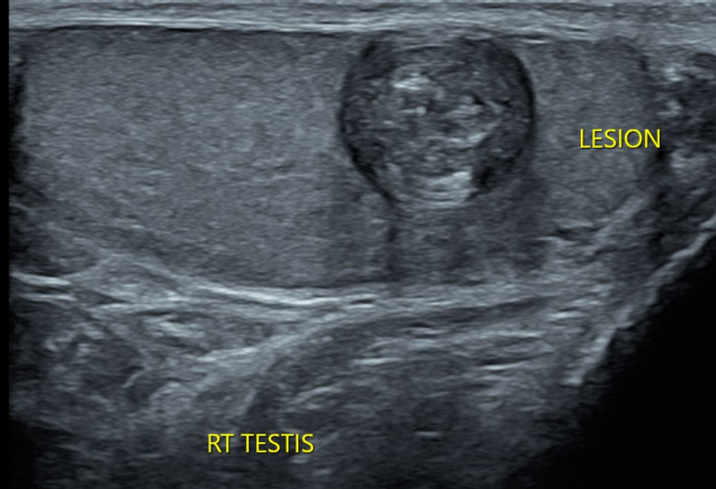 25 years old came to the hospital with Incidentally discovered painless ... 25 years old came to the hospital with Incidentally discovered painless ...