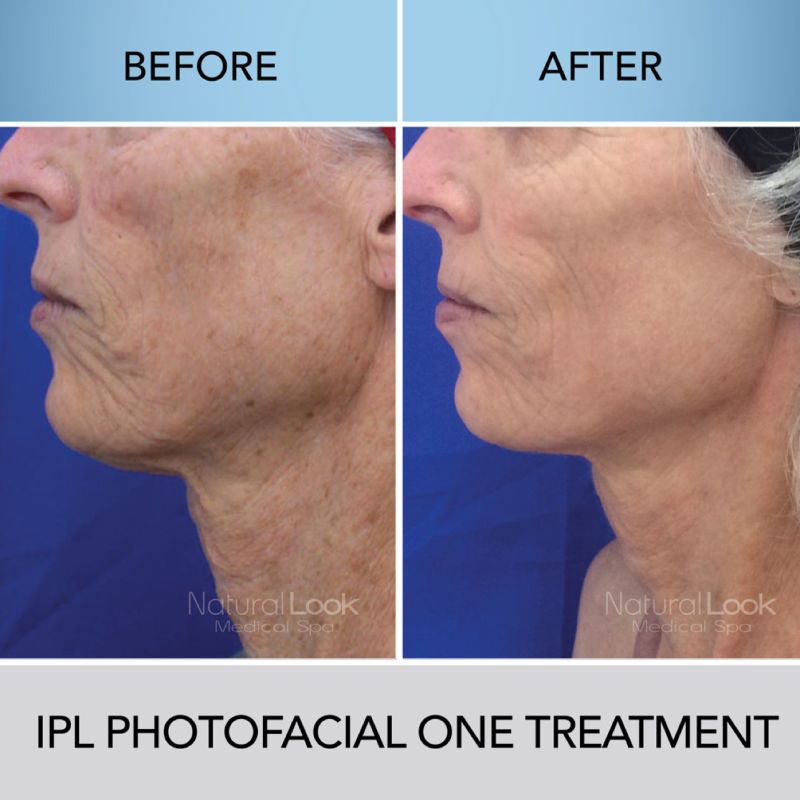 Natural Look Medical Spa on LinkedIn: #jeuveau #botox #naturallook # ... Natural Look Medical Spa on LinkedIn: #jeuveau #botox #naturallook # ...